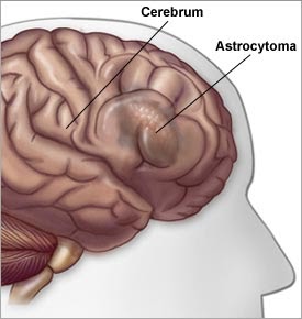 Cancer, A Lab Tech 's Perspective: Astrocytoma Brain Tumors